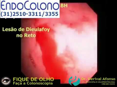 Tratamento da lesao de Dieulafoy do cólon - YouTube