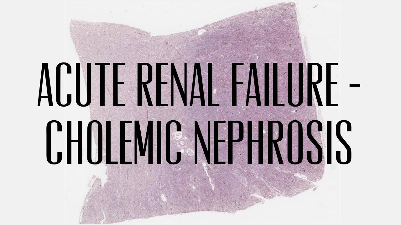 14. Acute renal failure cholemic nephrosis - YouTube