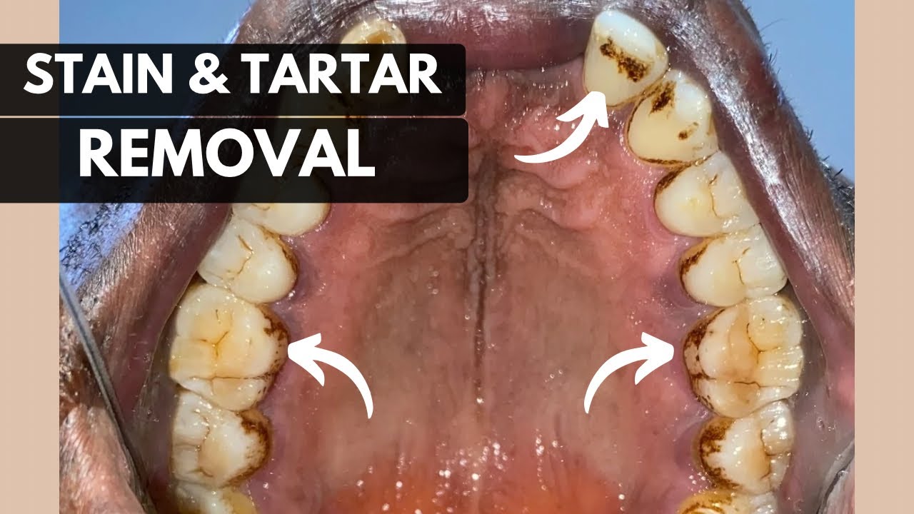 Get rid of Teeth Stains and Tartar | Teeth Cleaning - YouTube