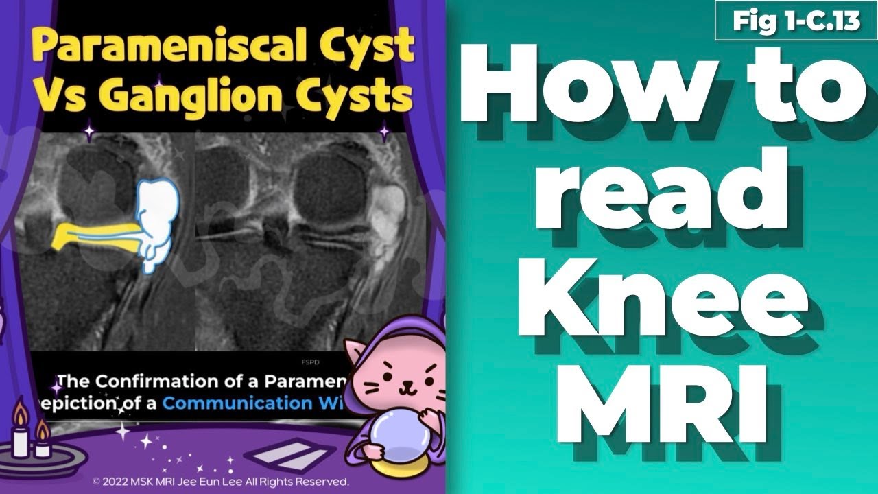 (Fig 1-C.13) Parameniscal cyst versus ganglion cysts - YouTube