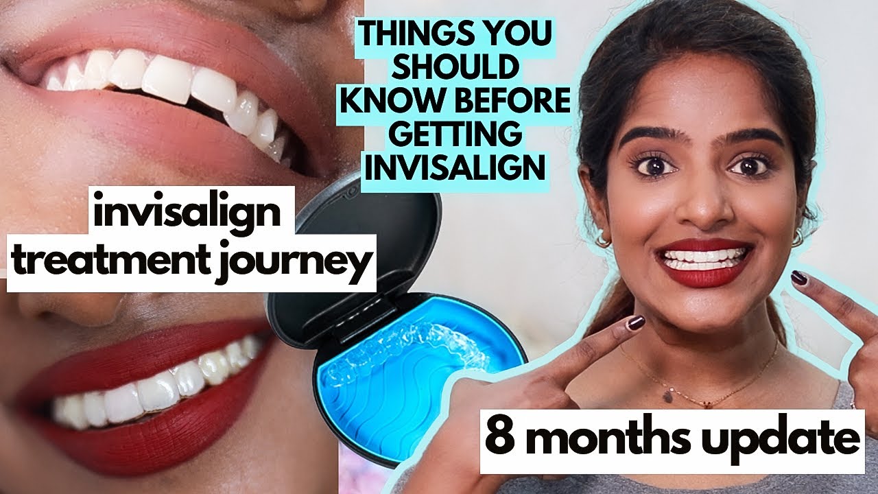Invisalign Journey Update🤫Things to know before Getting Invisalign🦷Cost ...