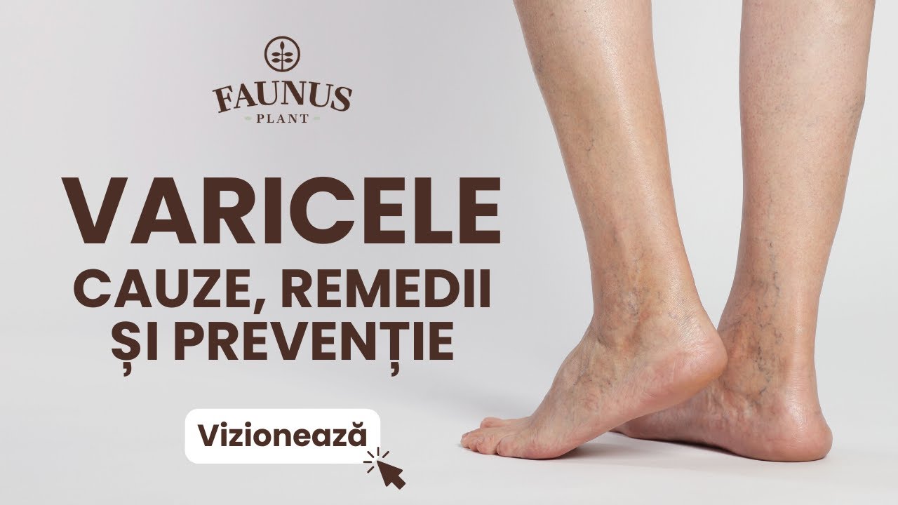 Varicele: Cauze, Remedii Naturale și Sfaturi de Prevenție - YouTube
