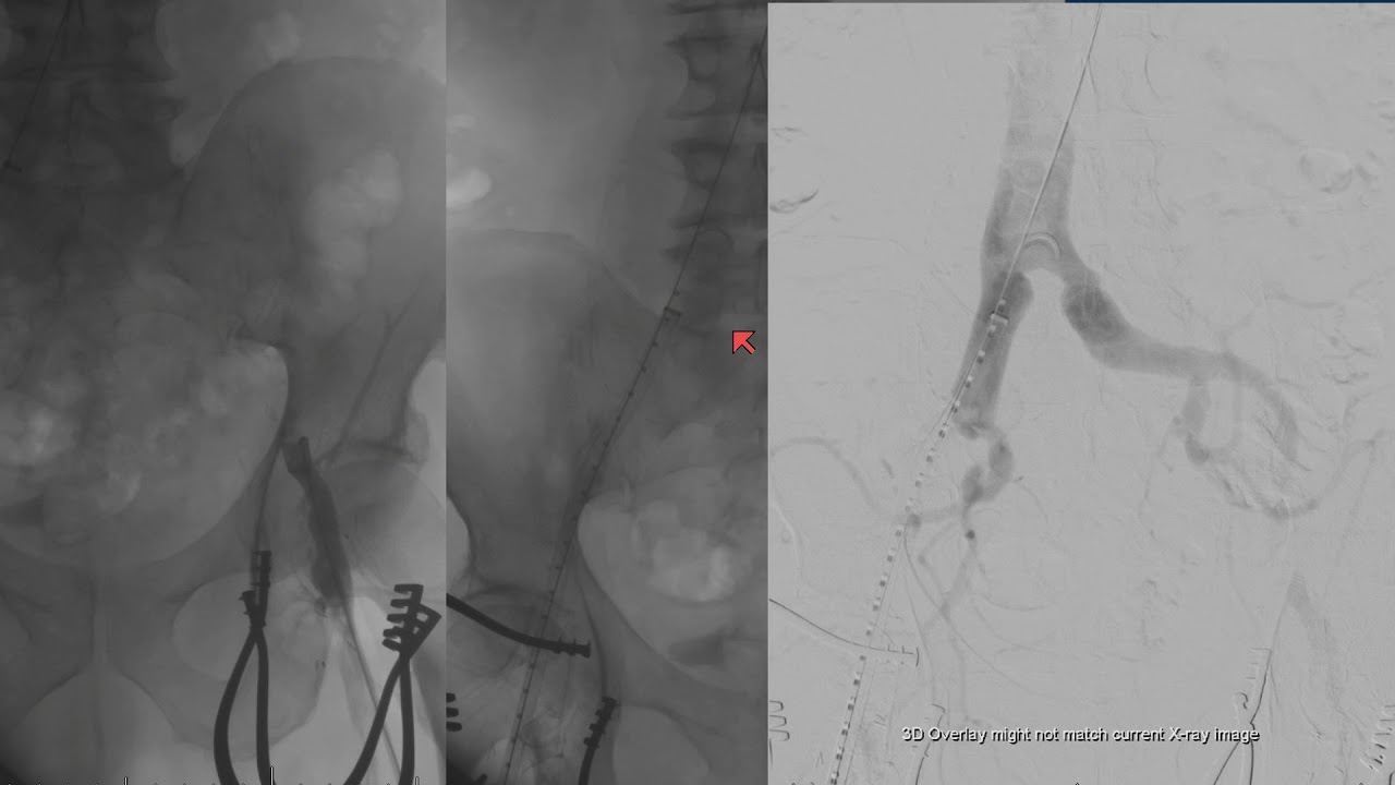 CASE PRESENTATION – Iliac Branch - YouTube