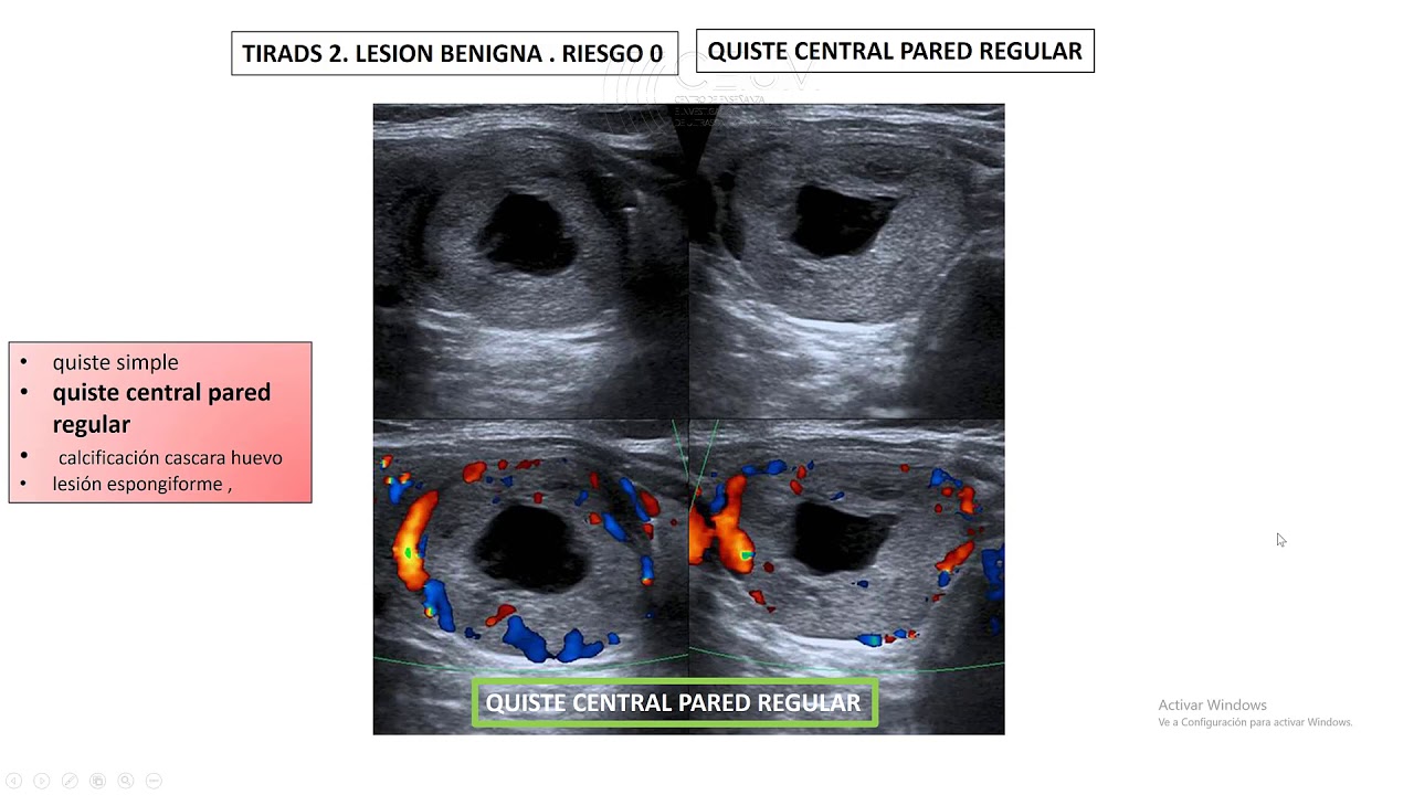 TI RADS CLASIFICACION TI RADS - YouTube