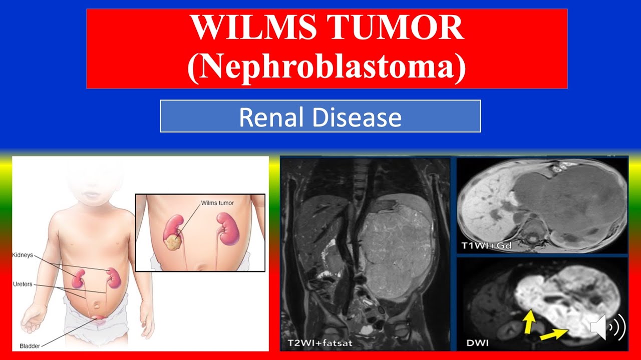 WILMS TUMOR (Nephroblastoma) - types, causes, pathophysiology, symptoms ...