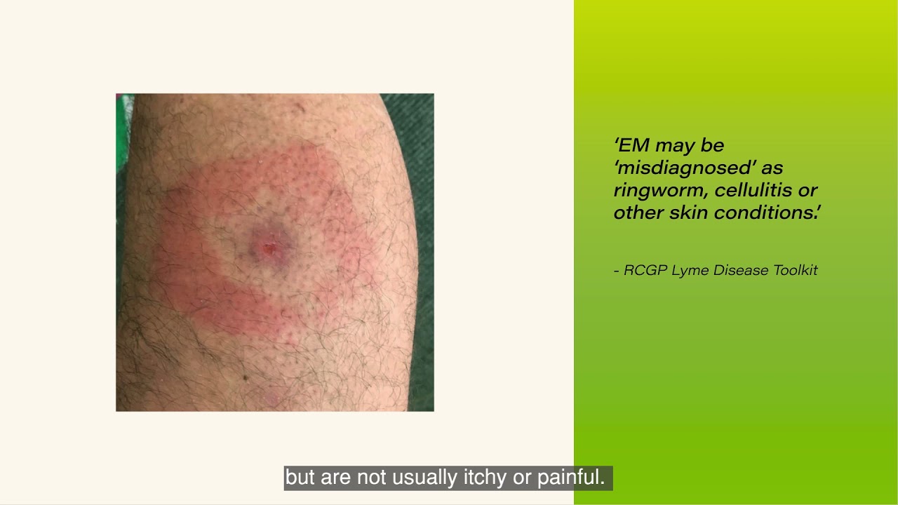 Lyme Disease - Key Points on Diagnosis, Testing and Treatment - YouTube