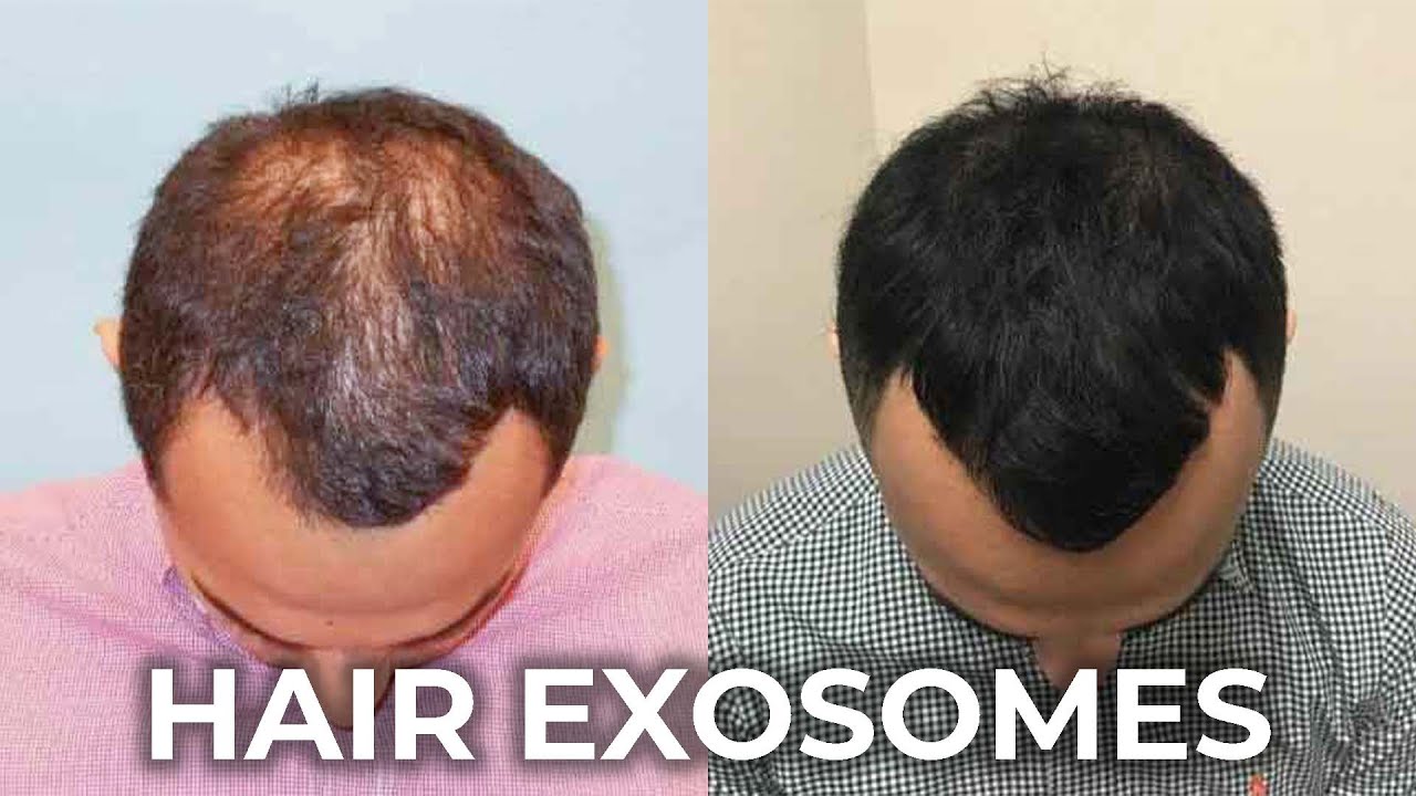 Thick & Healthy Hair with Exosomes Therapy: Before and After results ...