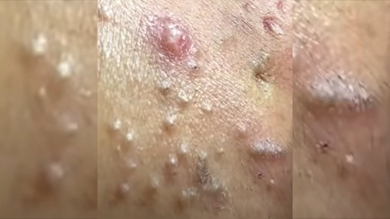 VIDEO: Blackheads Remove #21 - YouTube