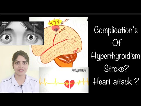 Hyperthyroidism# Complications of hyperthyroidism #Graves disease#AF# ...