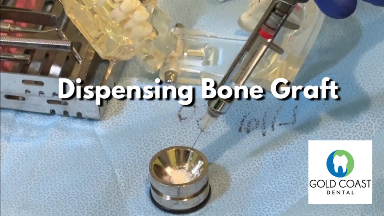 Dispensing Bone Graft - YouTube