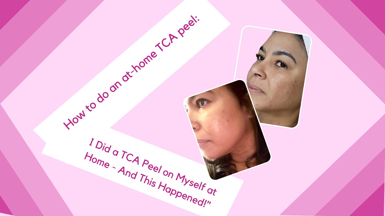 Revive Your Skin with TCA 13 Get a Fresh Glow Now! #TCApeel # ...