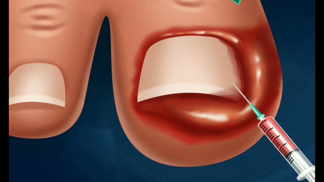 {ASMR} Toenail removal treatment animation || Asmr || Animation #asmr# ...
