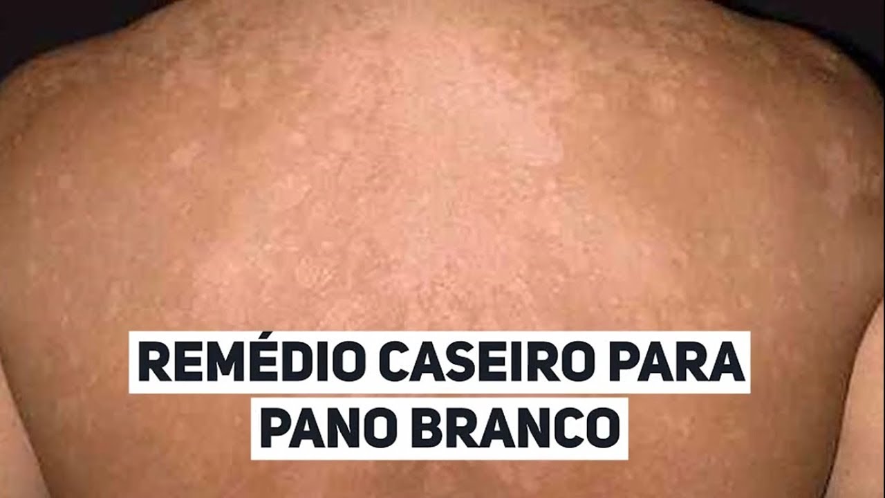 O Que é Bom Para Pano Branco Remédio Caseiro - RETOEDU