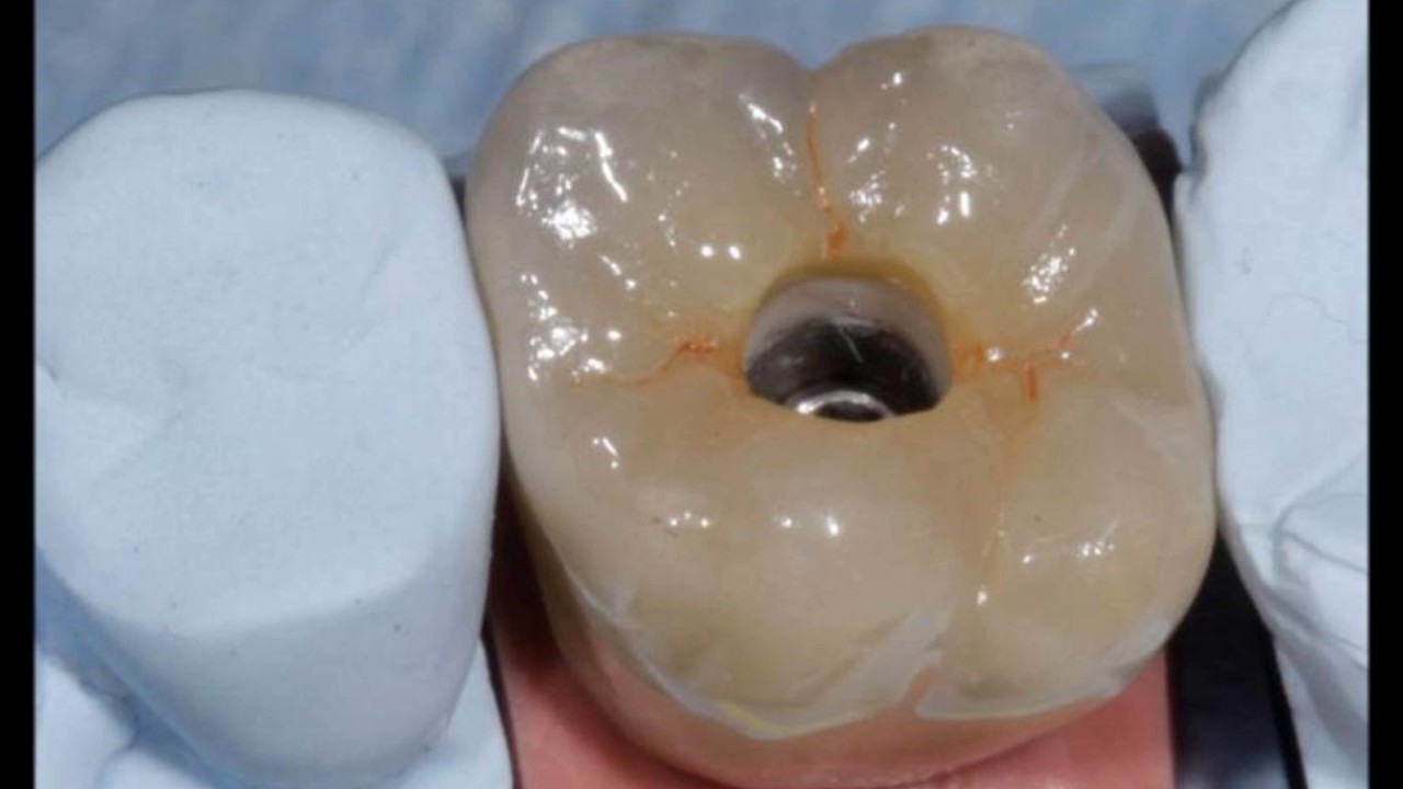 Implant, Socket lift, Slide show - YouTube