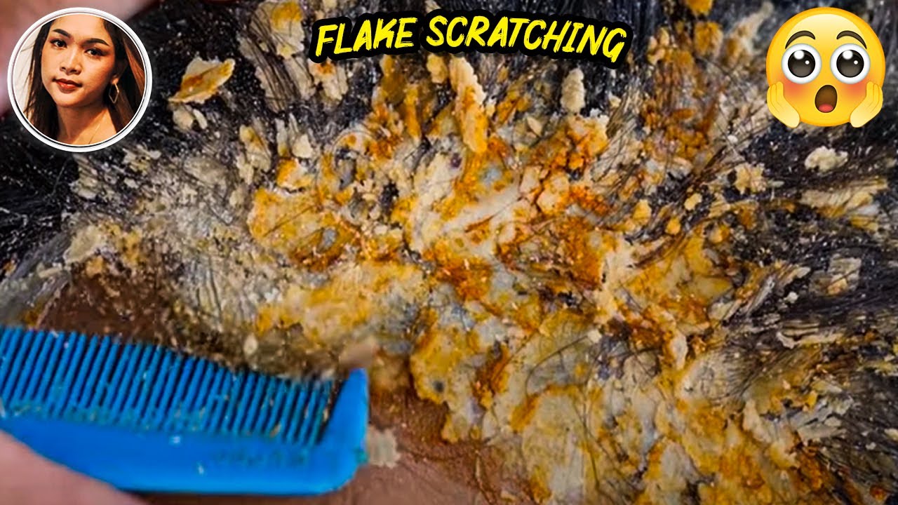 BIG DANDRUFF FLAKES Scalp scratching and picking Satisfying Dandruff ...
