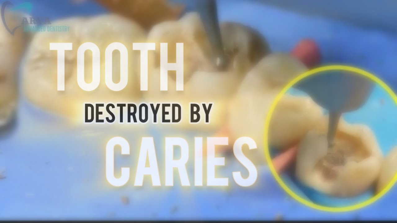 Restoration of tooth destroyed by Caries #teeth #dentalcare - YouTube