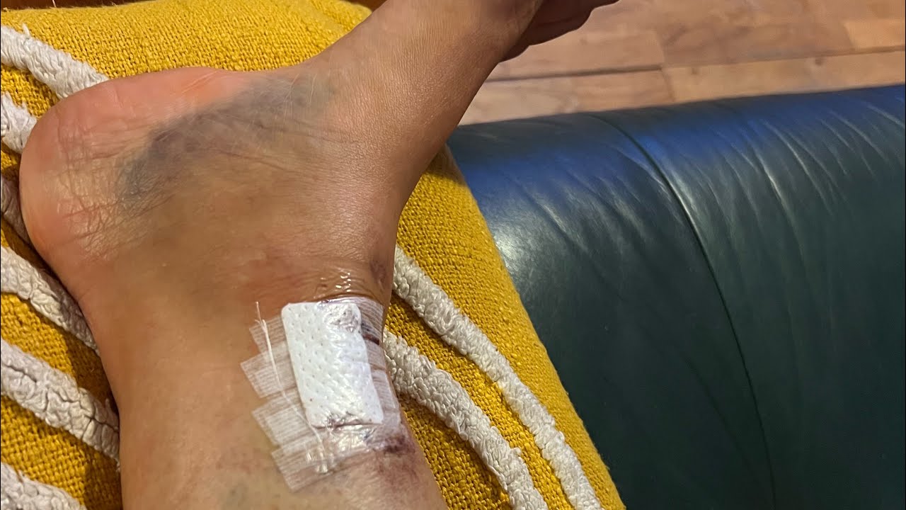 Update after surgery to remove screws after ankle fusion - YouTube