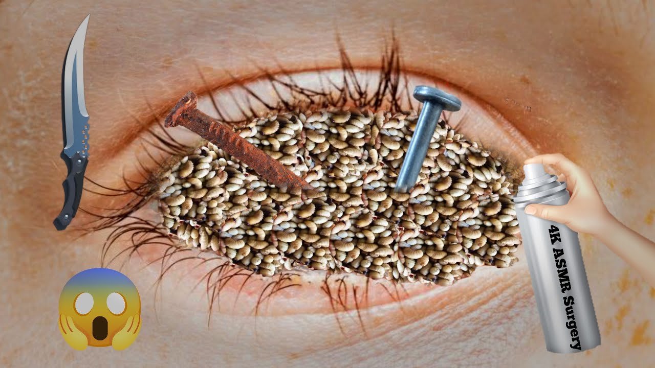 "ASMR Treatment from Infected eye & remove moggot,Worms , surgery ...