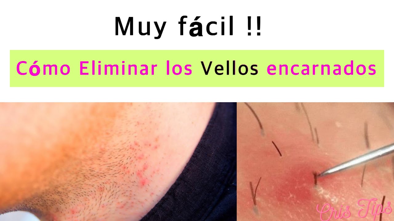 5 Remedios naturales para quitar los vellos encarnados - YouTube