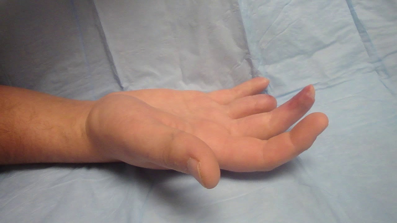 Right Long, Ring and Little Finger Crush Amputation Ulnar Side Long ...