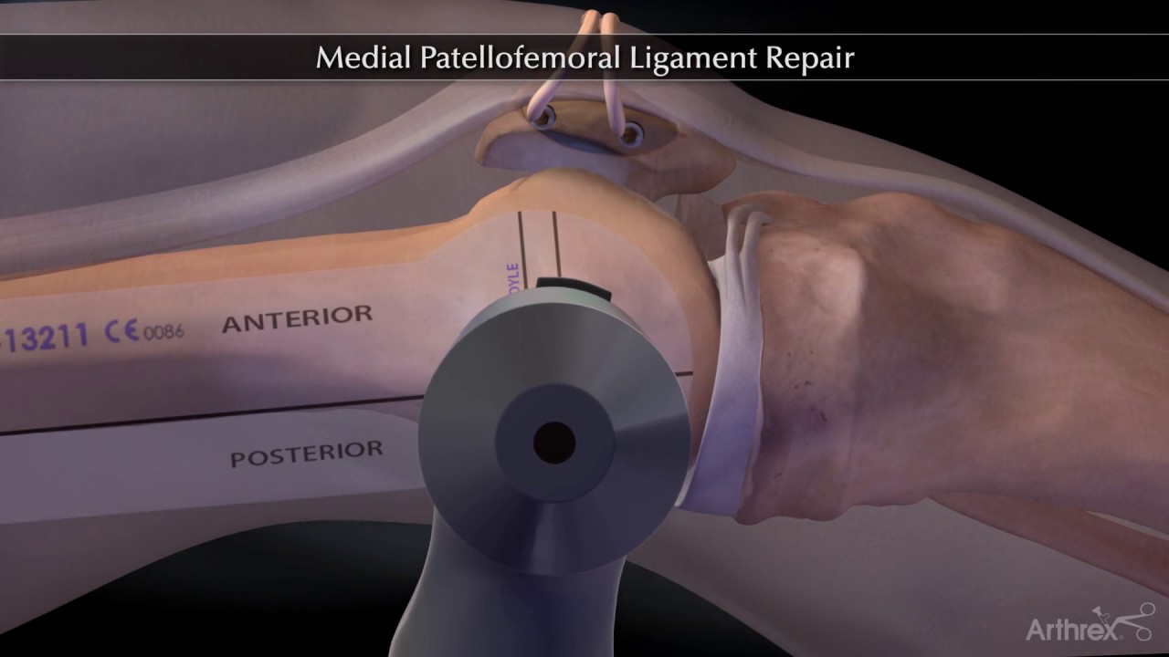 reconstruction du Reconstruction du ligament fémoro-patellaire médial ...