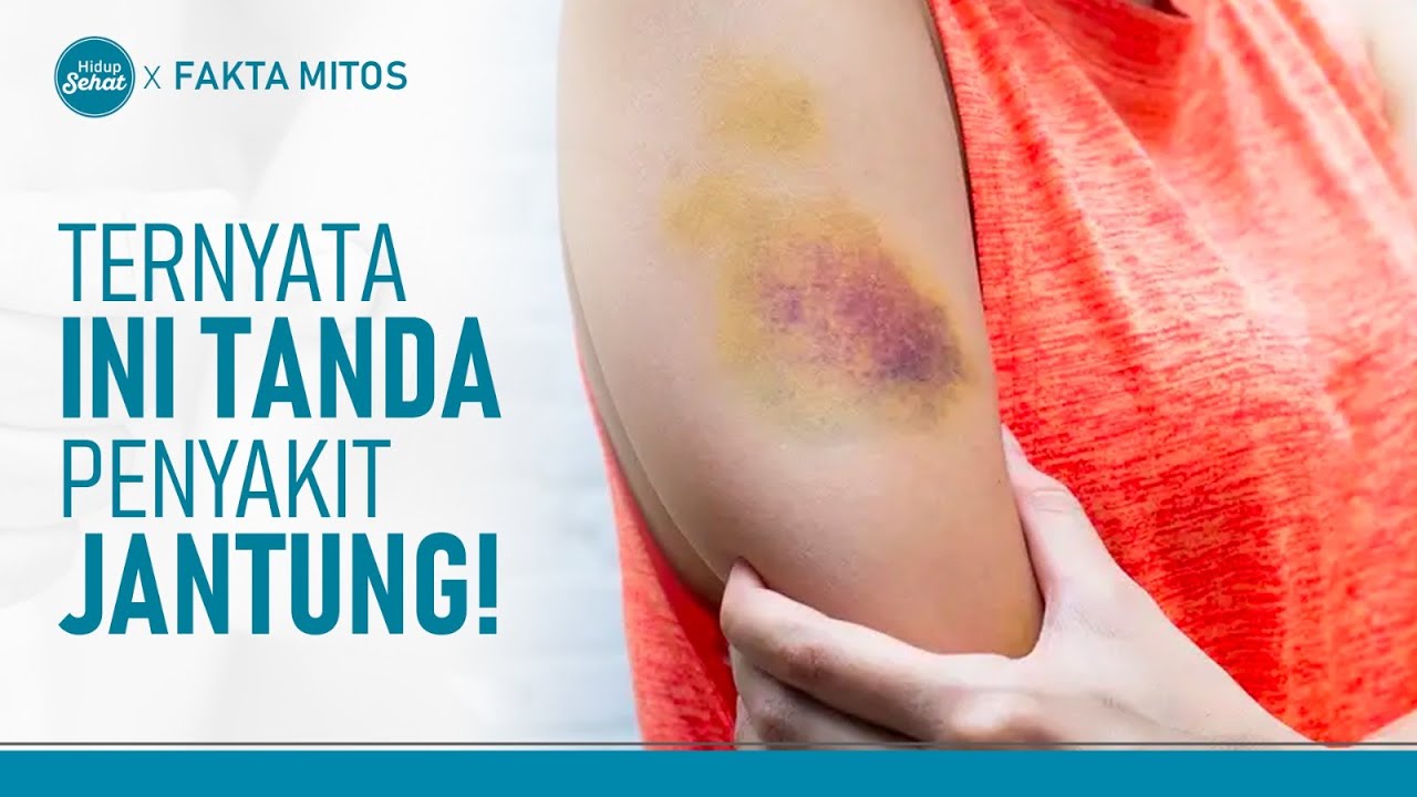 Muncul Lebam Biru Tiba-Tiba? Waspada Penyakit Jantung! | Hidup Sehat ...