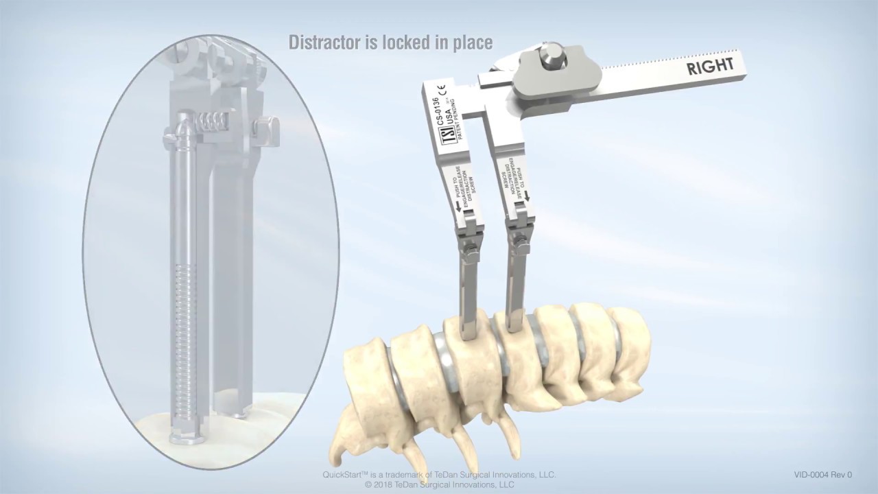 TSI QuickStart Distraction Screws - YouTube