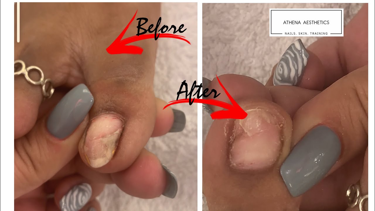 How to fix a broken toe nail, a quick tutorial to fix bad toe nail that is broke into half, toe ...