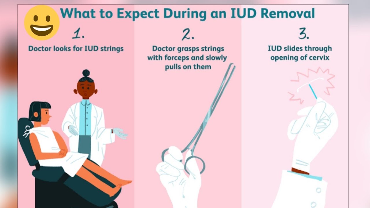 Removal Of Copper t Procedure Of Assisting The Removal Of removal-of-copper-t-procedure-of-assisting-the-removal-of