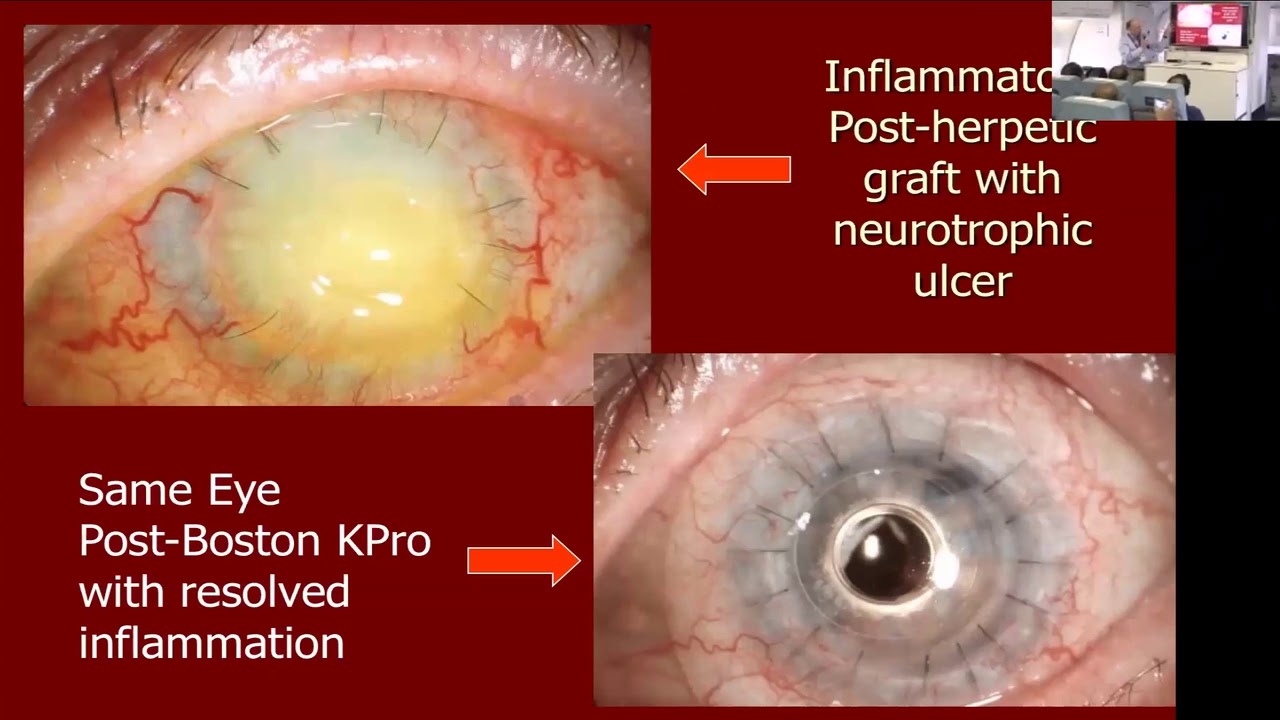 Lecture: The Current Role of the Boston Keratoprosthesis: Dr. Roberto ...