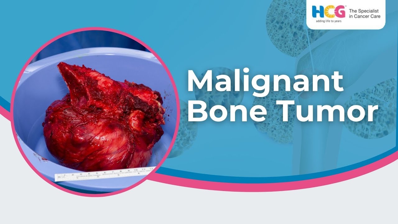 Malignant Bone Tumor | Treatment | Surgery | Amputation HCG Cancer ...