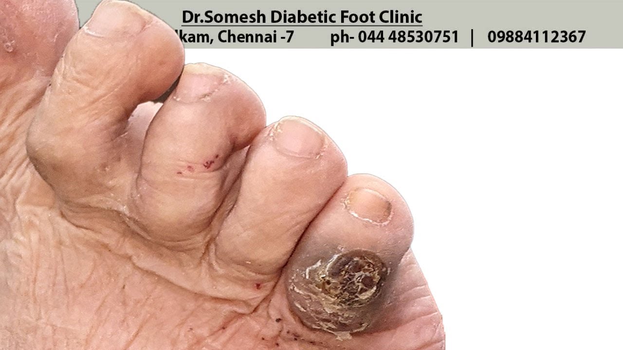 #Corn Little Toe Healing Before After Video - YouTube