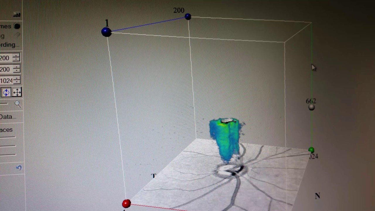 Deep Optic Nerve Cupping | OCT - YouTube