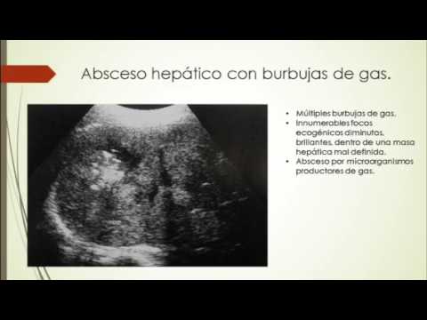 ABSCESO HEPÁTICO POR ULTRASONIDO CAUSAS SÍNTOMAS Y TRATAMIENTO, DRENAJE ...