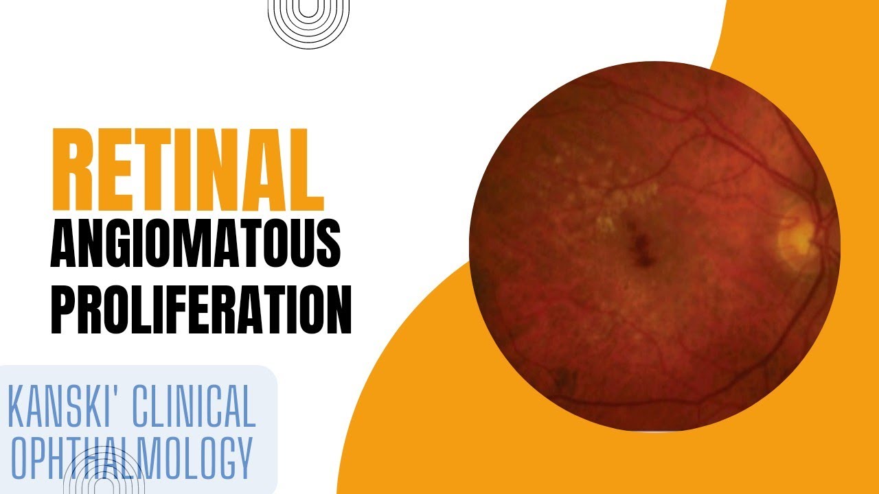 Retinal angiomatous proliferation (RAP)-Kanski's clinical ophthalmology ...