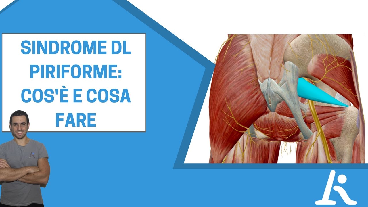 Sindrome del piriforme: cos'è e come si cura - YouTube