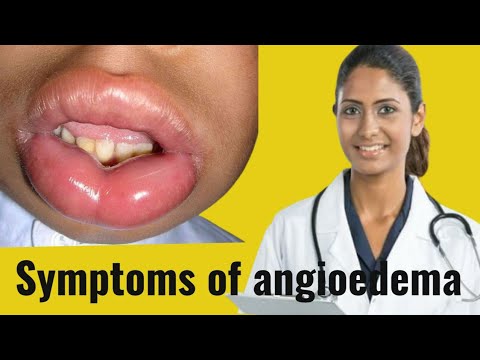Symptoms of angioedema - YouTube