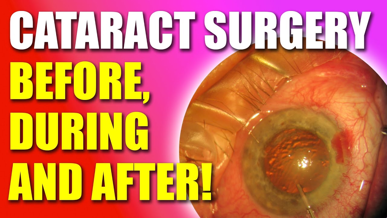 CATARACT Surgery in 2024 - Before, During and After! - YouTube