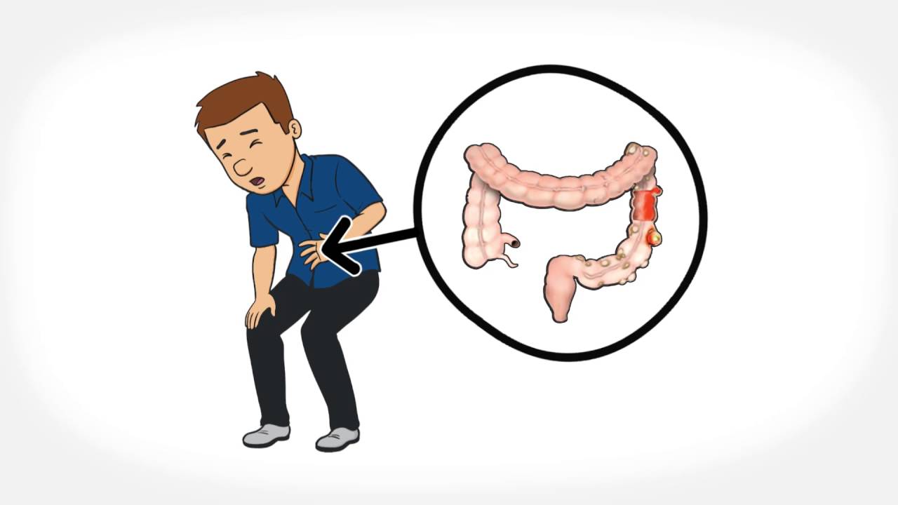 How To Treat Diverticulitis - YouTube
