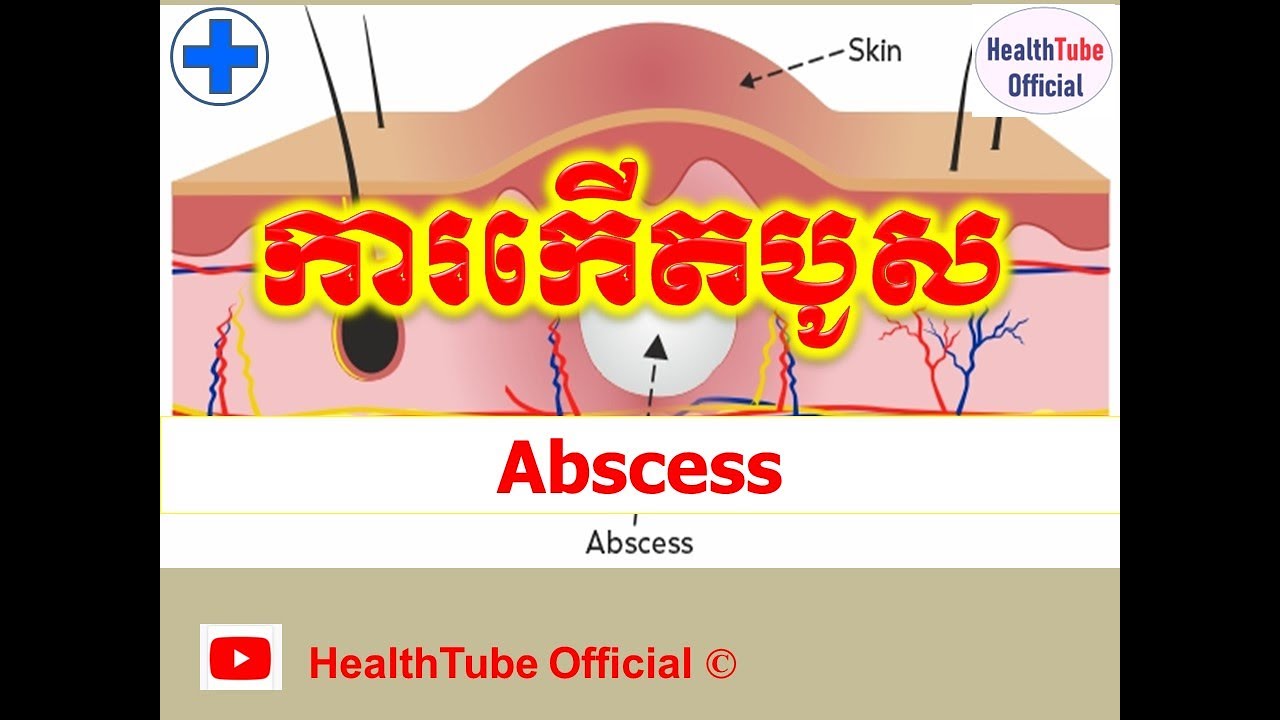 ការកើតបូស l Symptoms and prevention of Abscess l សុខភាពស្បែក l ...