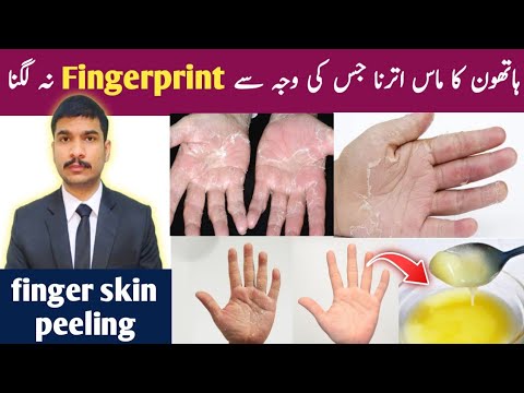 finger skin peeling🖐 hathon ka mass utarna