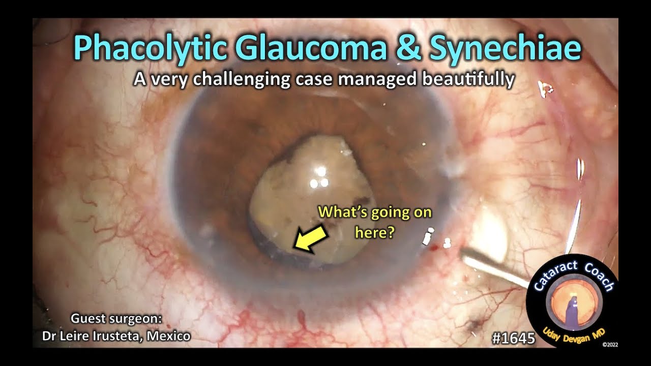 CataractCoach 1645: phacolytic glaucoma & synechiae - YouTube