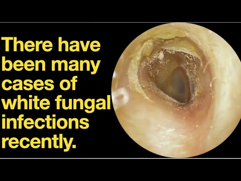 There have been many cases of white fungal infections recently.|ear wax ...