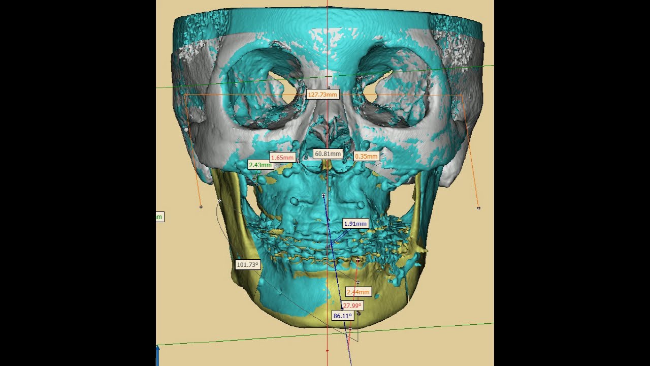[3D-Orthognathic surgery] Facial asymmetry, Mandibular prognathism ...