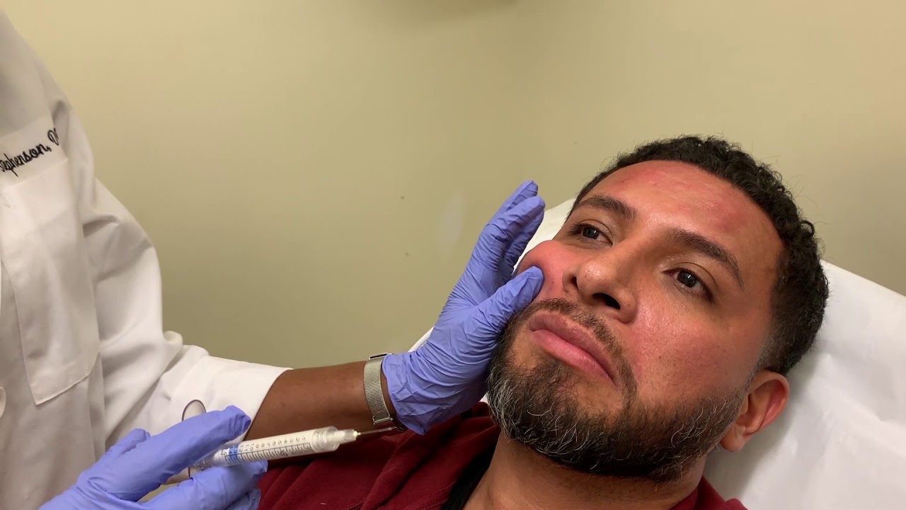 Male Filler Treatments - YouTube