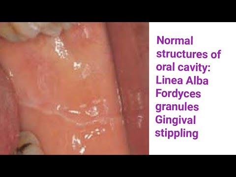 Normal structures inside oral cavity ,Linea Alba, Fordyces granules ...