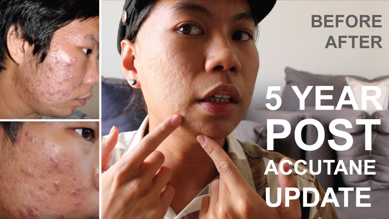 5 YEAR POST ACCUTANE UPDATE, BEFORE & AFTER, WHY I STILL BREAK OUT AND ...