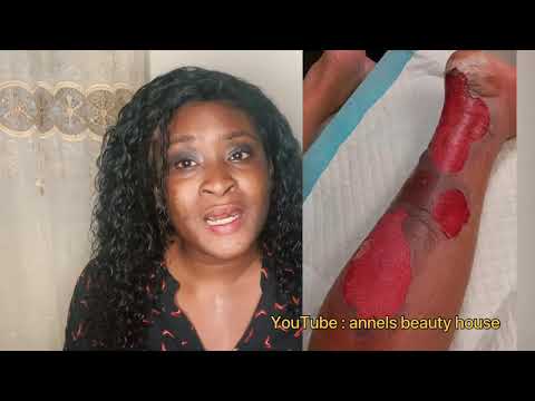 HOW I SURVIVED A FIRE ACCIDENT THAT BURNT MY TWO LEGS / GODS MERCY ...