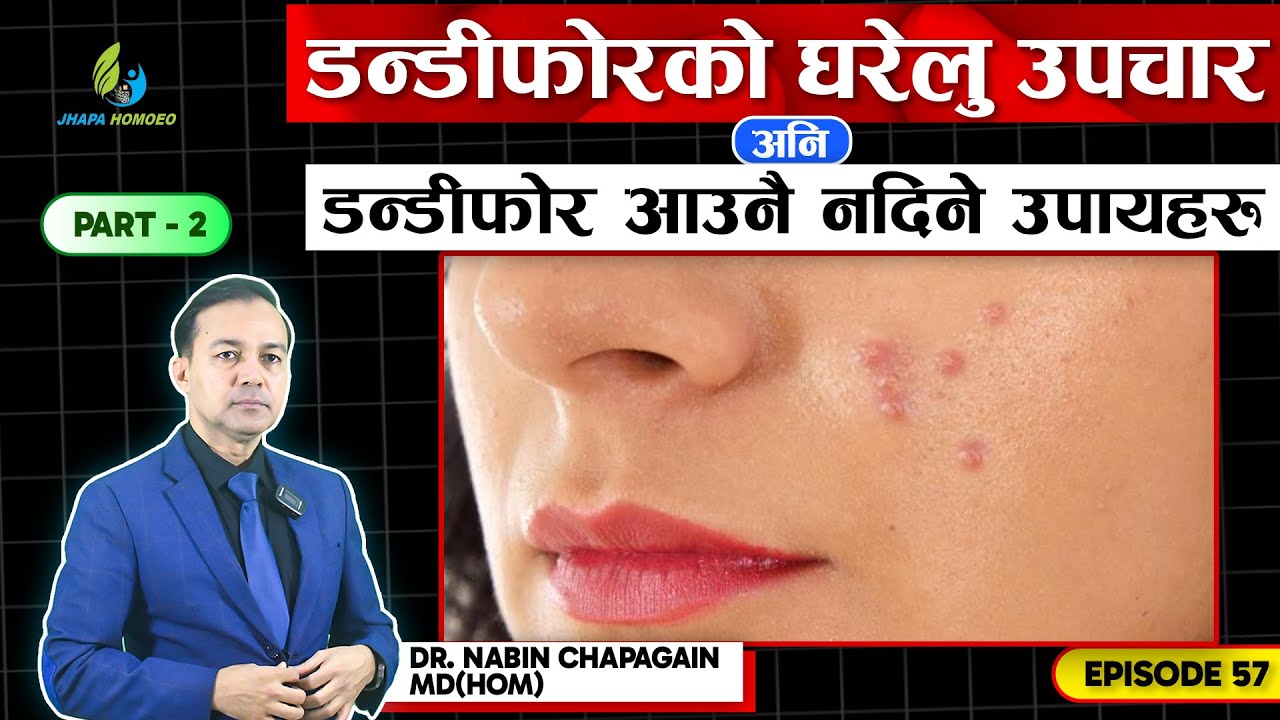 डन्डीफोरको घरेलु उपचार र डन्डीफोर आउनै नदिने उपायहरु | Ep-57 | Dr. Nabin Chapagain - YouTube
