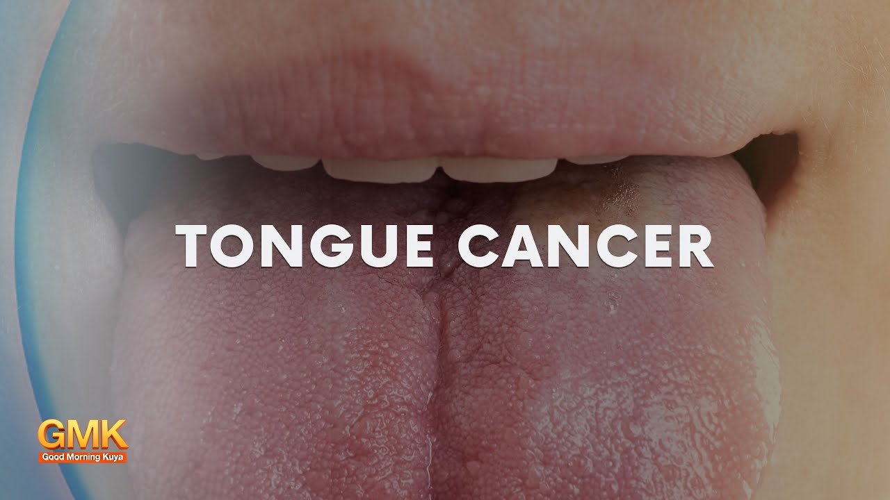 Tongue Cancer (Part 2) | Usapang Pangkalusugan - YouTube